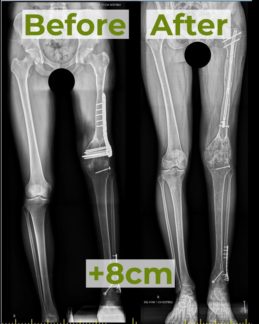 GoLengthening | Premium Cosmetic Stature Lengthening