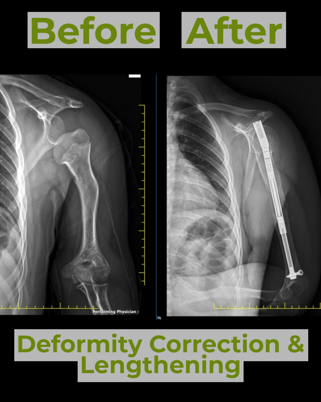 GoLengthening | Premium Cosmetic Stature Lengthening